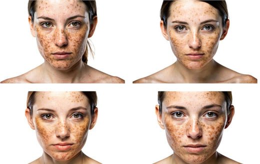 How to Fix uneven Skin Tone for a Flawless Complexion