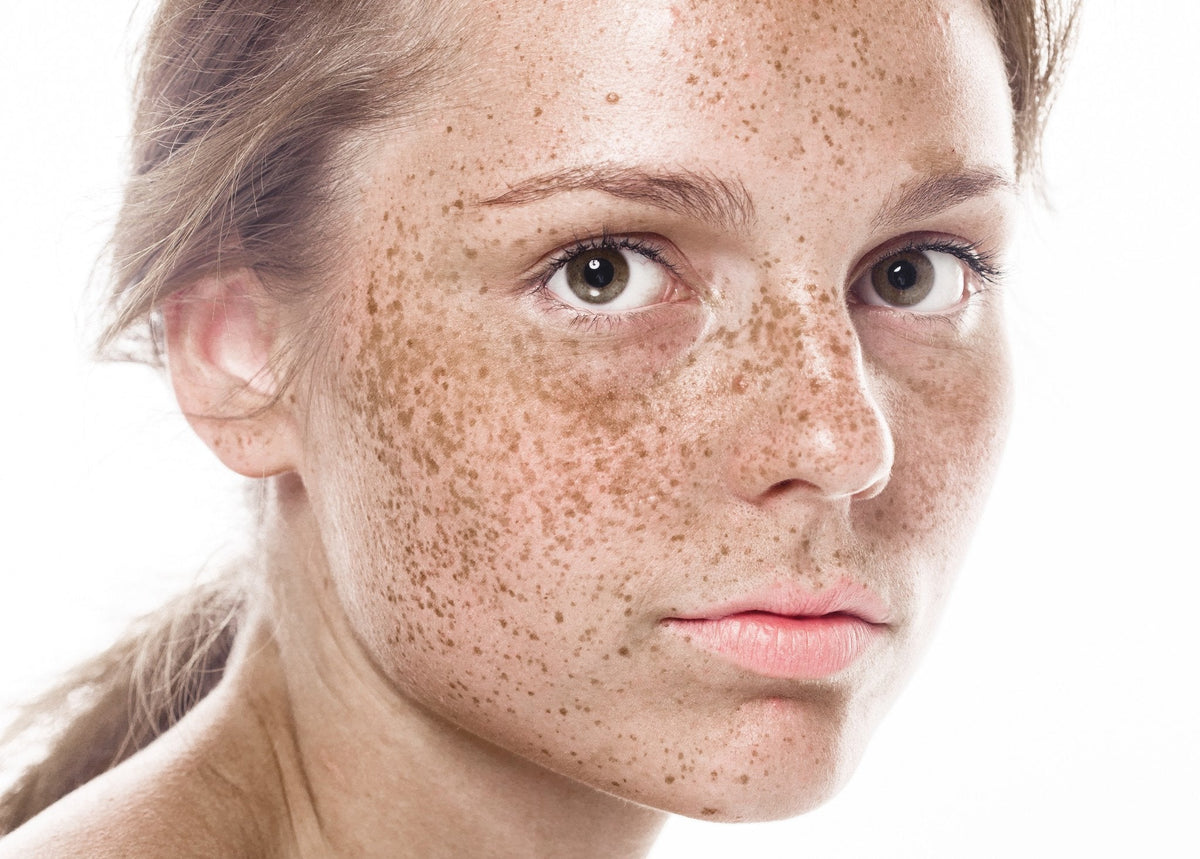 Natural Remedies For Dark Spots On Face And Body